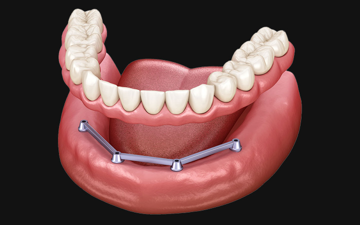 Best Dentures In Lahore | Pro Fitting & Excellent Care